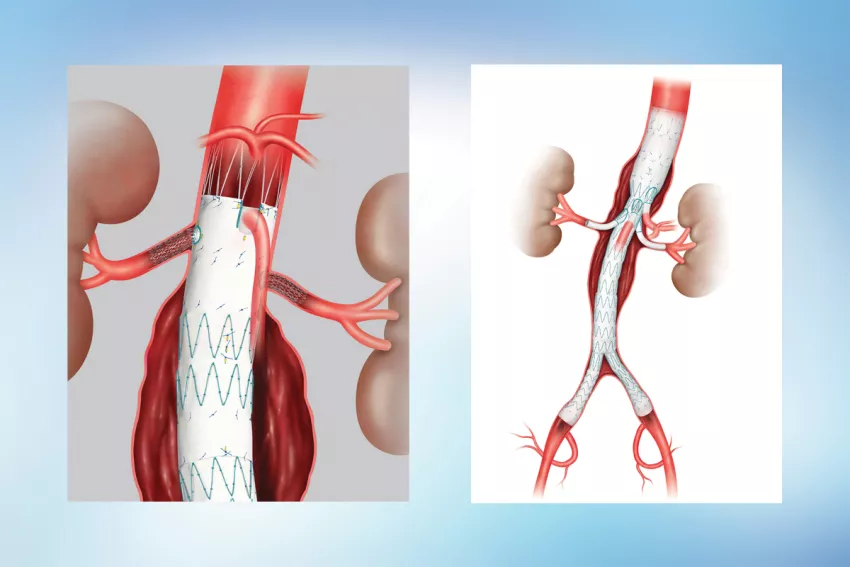 Key Takeaways For Managing Abdominal Aortic Aneurysms Umass Memorial Health The Pursuit